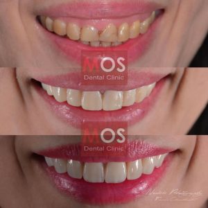 วีเนียร์ (Veneer) คืออะไร ราคาเท่าไหร่ ข้อดีข้อเสีย - คลินิกทันตกรรม MOS Dental Clinic