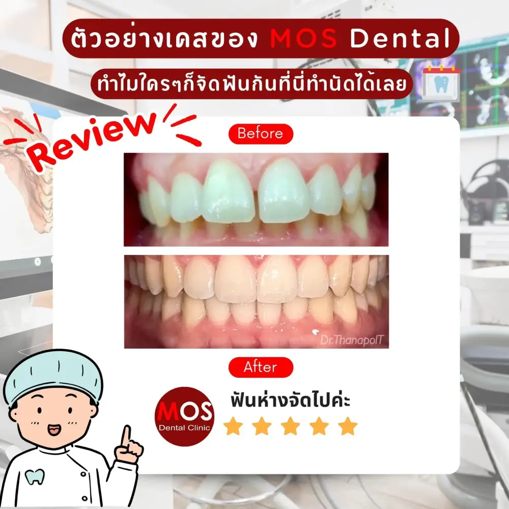 ฟันห่างเกิดจากอะไร แก้ยังไง ทำไมจัดฟันแล้วฟันห่าง - คลินิกทันตกรรม MOS Dental Clinic